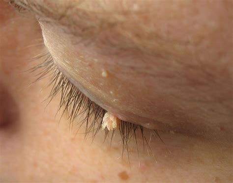Wart Description Cause Types And Treatment Britannica