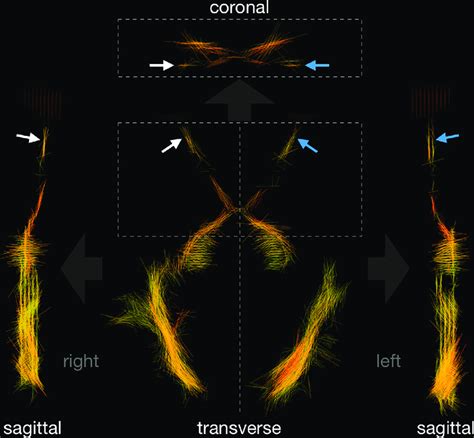 Visual Pathway Shape On Different Plane Projections White And Blue