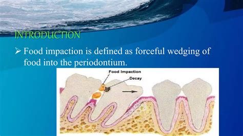 Food Impaction And Treatment Pptx