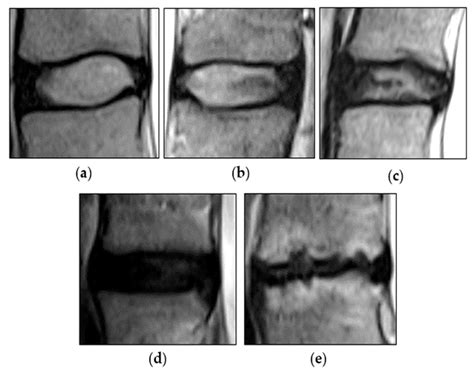 Diagnostics Free Full Text Automatic Detection Classification And Grading Of Lumbar