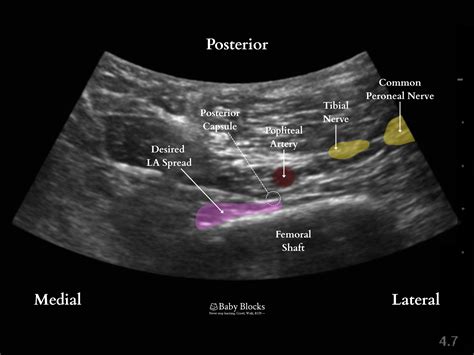 Motor Sparing Pediatric Ipack Block Usg Posterior Knee Analgesia For
