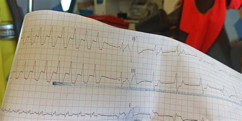 Management Of Supraventricular Tachycardia Virginia Arrhythmia