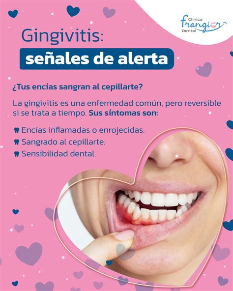 Clínica 🦷 Gingivitis Señales De Alerta 🦷 ¿tus Encías Sangran Al
