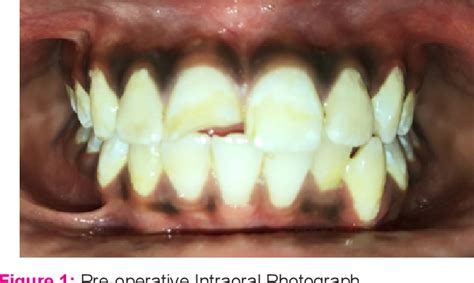 Figure 1 From Aesthetic Rehabilitation Of Ellis Class Ii Fracture Using The Template Technique