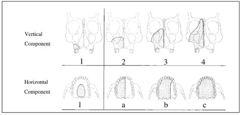 Classification Defect Of Maxilla Vertical Component Type I