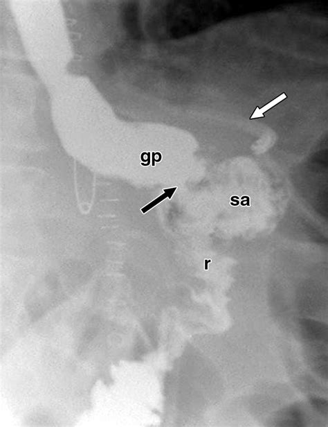 Roux En Y Gastric Bypass Upper Gi