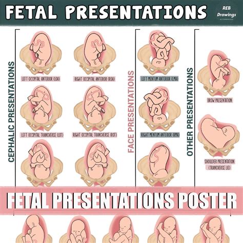 Face Presentation Mentum Posterior