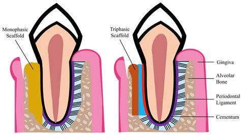 Hierarchical Biomaterial Scaffolds For Periodontal Tissue Engineering Recent Progress And