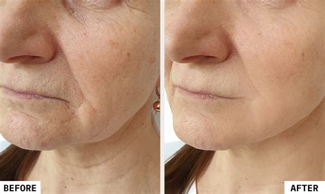 Hifu Facial Advanced Skin Tightening Treatment Kaya