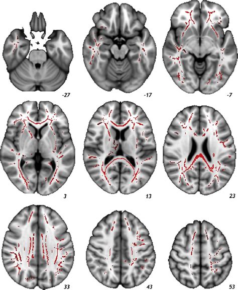 E Maps Of Correlations Between Fa Values And Memory Performance In Download Scientific Diagram