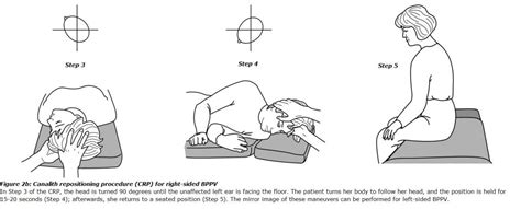 Canalith Repositioning Procedure For Bppv Vestibular Disorders Association