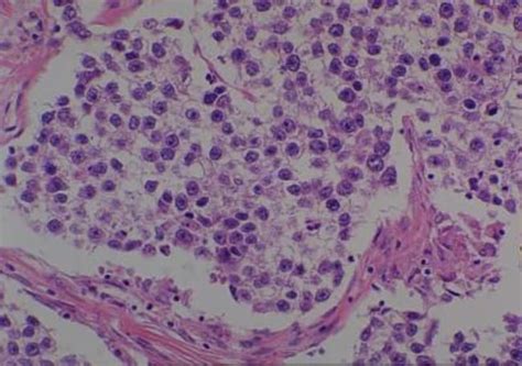 Novus Biologicals™ Human Ovary Tissue Microarray Cancer Human Ovary