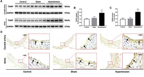 Figure 1 From Role Of Thioredoxin Interacting Protein In Mediating