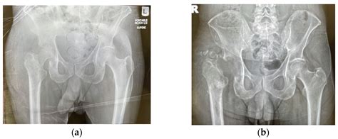 Atypical Staphylococcal Septic Arthritis In A Native Hip A Case Report