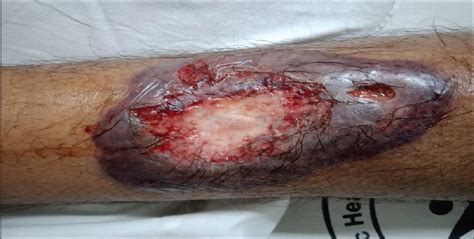 Pyoderma Gangrenosum Associated With Ulcerative Colitis And Clinical Dermatology Review