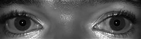 Right And Left Irises Of Volunteer A Without Spectacles Download Scientific Diagram