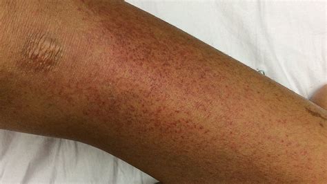 Petechiae Causes Treatments Pictures And More