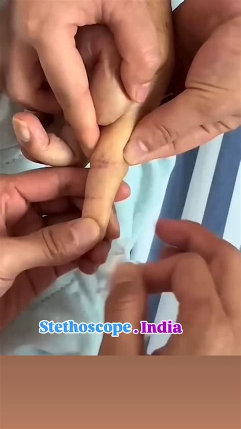 Aiims Hyperkalemia Vs Hypokalemia Very Important For Every