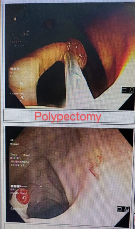 Polypectomy Dhimans Gastro Clinics
