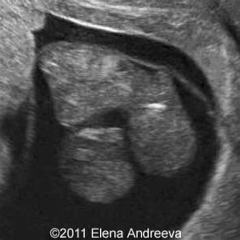 📃 Conjoined Twins