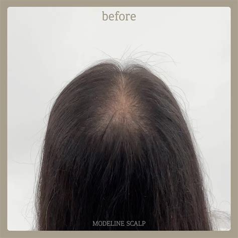 두피문신 두피문신후기 여자두피문신 정수리두피문신 시간이지나도 이쁘게 ️ Youtube