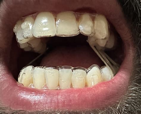 Does This Look Like Poor Tracking My Dentist Says It Looks Normal To Him But Im Still