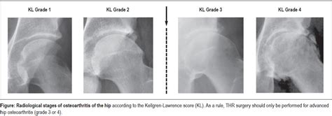 Total Hip Replacement For Osteoarthritis 29102021
