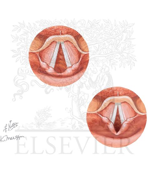 Vocal Cord Dysfunction Vocal Cord Paralysis Voice Box Disorder