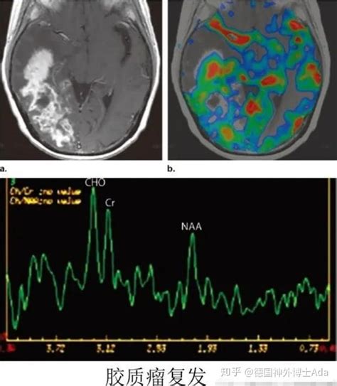 Mr图谱 放射性脑损伤 Vs 胶质瘤复发 知乎