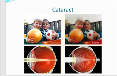 Clin Med 3 Adult Visual Abnormalities Flashcards Quizlet