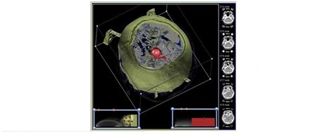 Segmentation Of Brain Tumors From Mri Yttrium Technology
