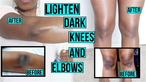 How To Lighten Dark Knees And Elbows Fast And Naturally Youtube