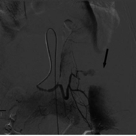 Post Embolization Angiogram Demonstrating Coils In Segmental Branch Of Download Scientific