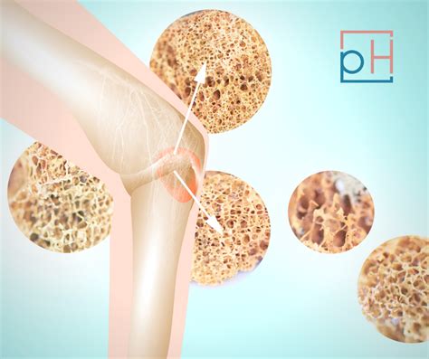 Calcitonin Function Uses And Side Effects Primehealth Denver Calcitonin Function Uses And Side Effects Primehealth Denver