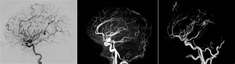 Cerebral Vasculature Imaging Of A Healthy Subject Left 2d Dsa Near