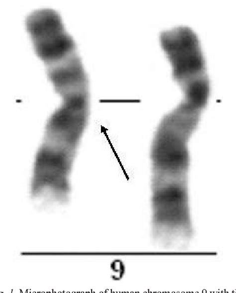Figure 1 From Pericentric Inversion Of Human Chromosome 9 Epidemiology