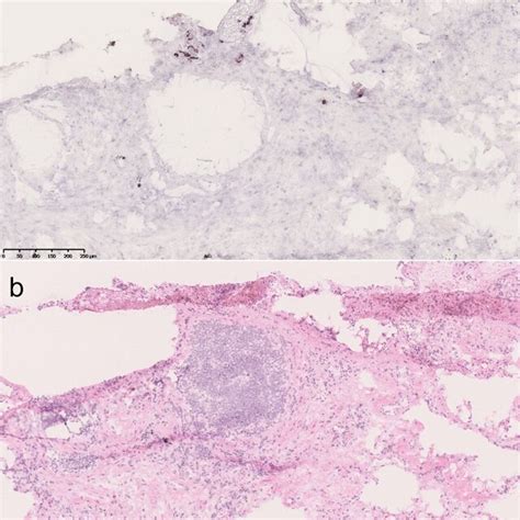 Isolated Tumor Cells Of Intrathoracic Lymph Node By Rapid Download Scientific Diagram