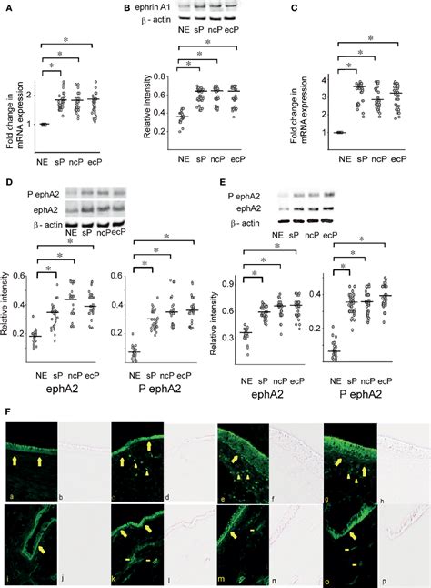 Figure 1 From The Expression Of Ephrina1 Epha2 Receptor Increases In
