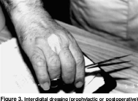 Figure 3 From Interdigital Pilonidal Cyst Semantic Scholar