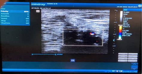 Ease Of Single Prick Popliteal Sciatic Block In A Modified Lateral Position