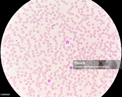 Photomicrograph Suggestive Of Megaloblastic Anemia To Rule Out