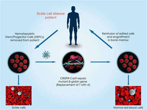 Crispr Sickle Cell Gene Therapy Approaches Challenges And Progress