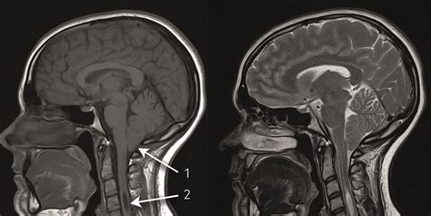Chiari Malformations Principles Of Diagnosis And Management The Bmj