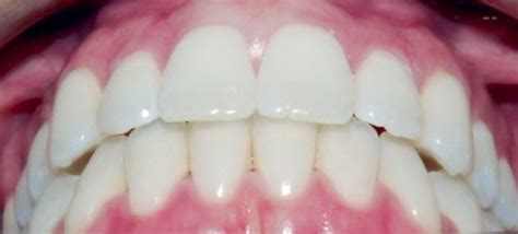 Esthetic Dentistry And Occlusion Pocket Dentistry