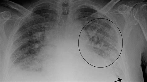Congestive Heart Failure X Ray