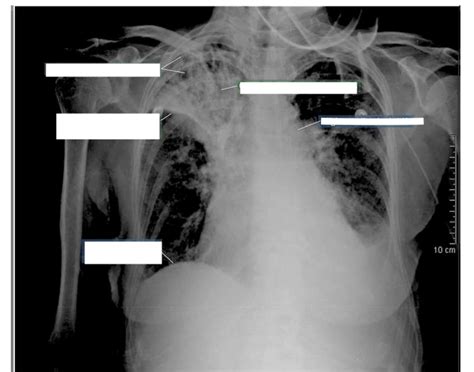 Cxr Atelectasis 2 Quiz