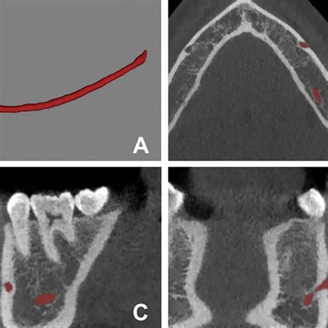 Mandibular Canal Segmented Seen In A 3d View A Axial View B