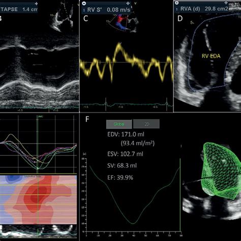 echocardiographic assessment of the rv systolic function in an adult