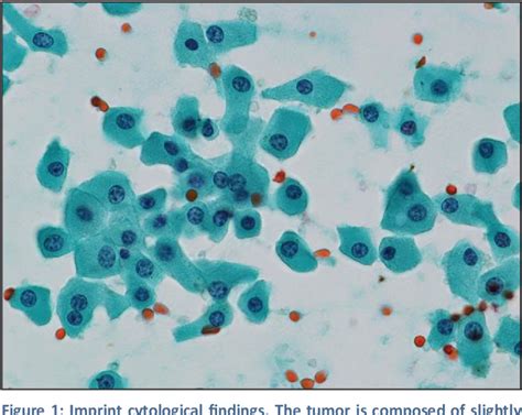 Figure From Chromophobe Renal Cell Carcinoma Oncocytic Variant Cytological And