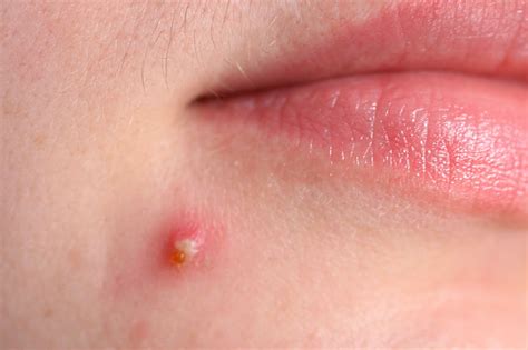 Acne What Went Wrong